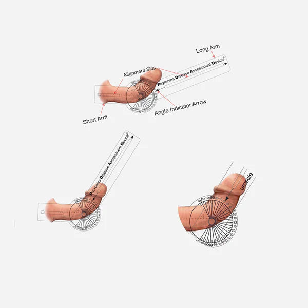 Benefits Of Penile Traction For Peyronies Disease